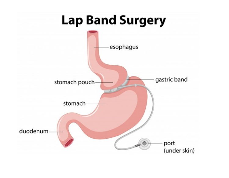 Top 5 Tips for Success After Lap Band Surgery - Hospital Nino Jesus