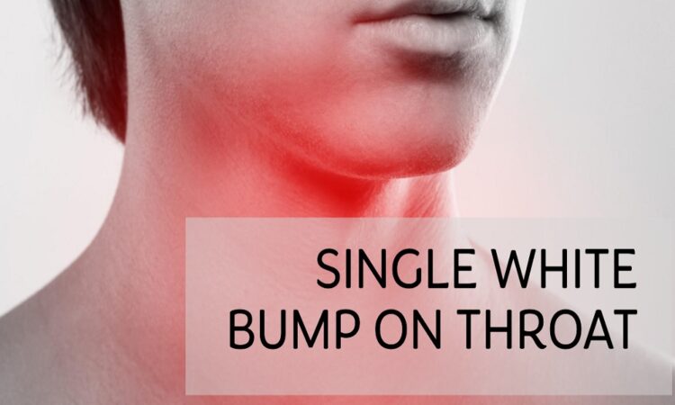 Single White Bump on Back of Throat - Hospital Nino Jesus